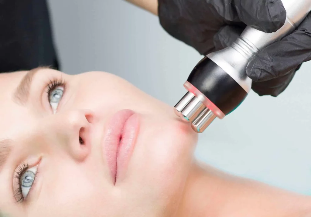 RF Facial Skin Tightening in Avon | Samara MedSpa